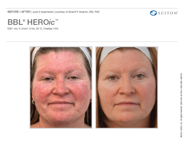 BBL HEROic – Ketchum Dermatology